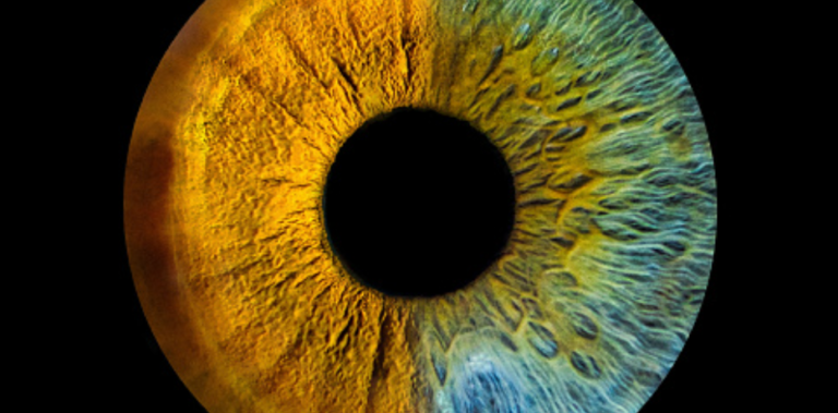 Aniridia - Qué es, causas, síntomas y tratamientos disponibles